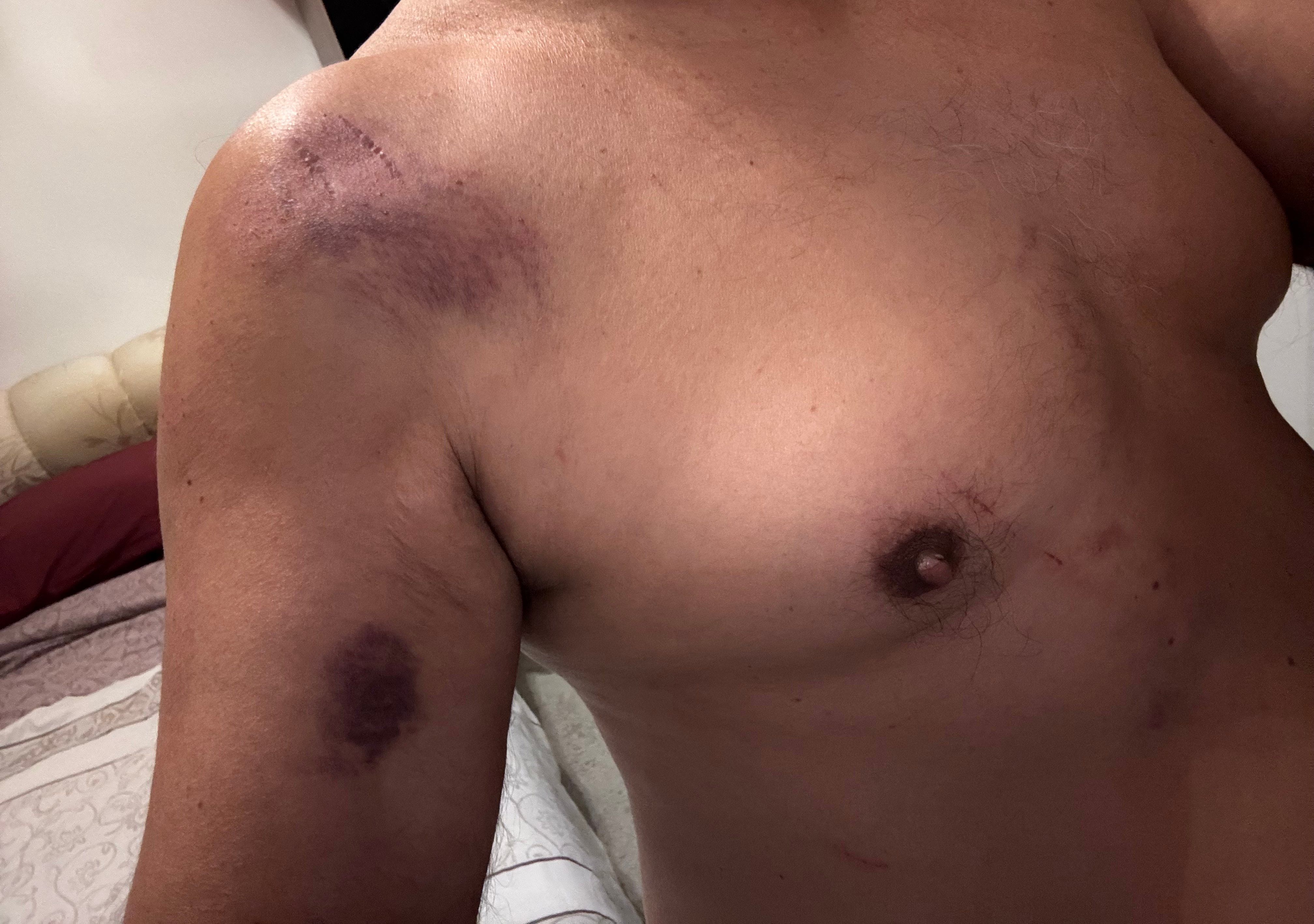 Walker claims he was mauled by ‘leopard’ in Surrey Hills attack ...